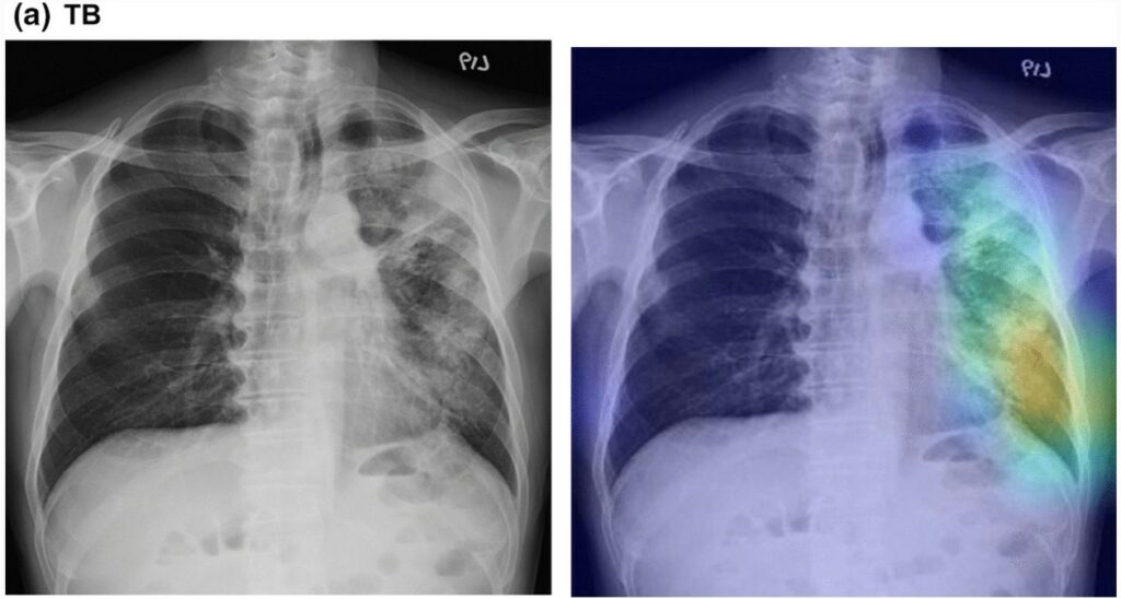 A deep learning model using chest X-ray to identify TB and NTM-LD patients - AI Blog - ESR ...